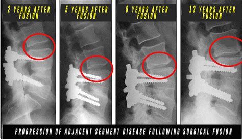 The Hidden Risk Of Spinal Fusion Adjacent Segment Disease