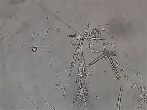 Birefringent Crystals Archives Medical Notes