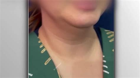 جراحی ساکشن گردن دکتر خوروش نماشا