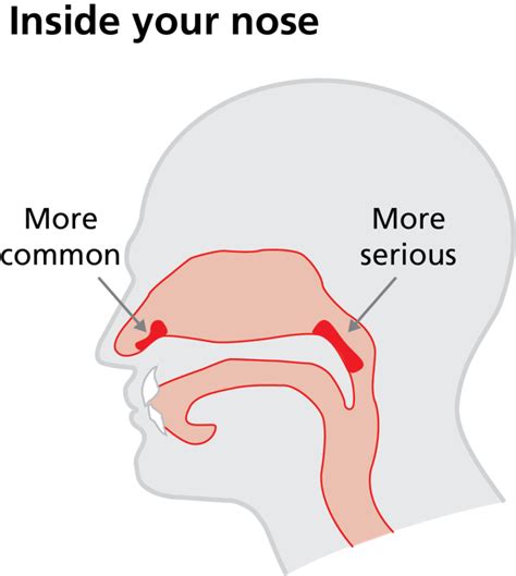 Nosebleed Digital Patient Information Hub