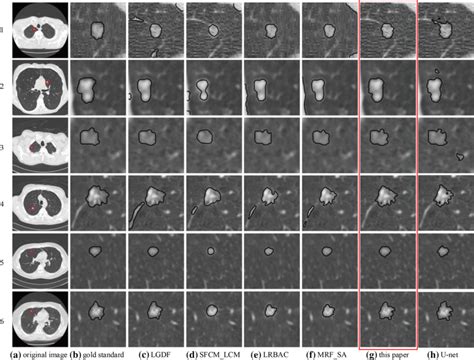 Segmented Results Of Lidc Idri Data Download Scientific Diagram