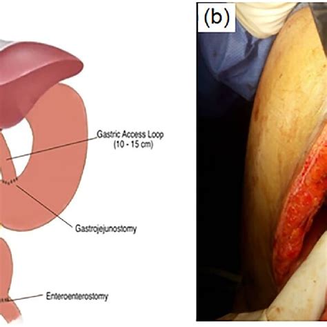 Hepaticojejunostomy With Gastric Access Loop A Illustrative Diagram B Download Scientific
