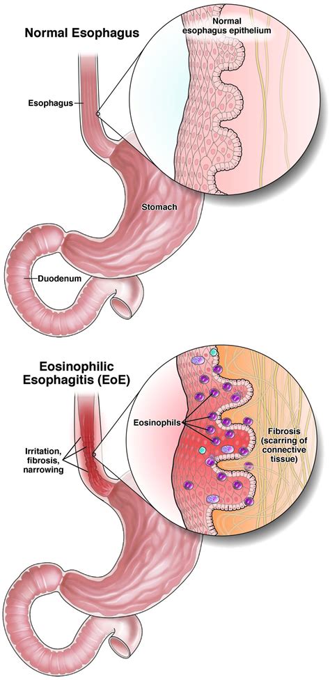 Eosinophilic Esophagitis Eoe Resource Center Aga Gi Patient Center
