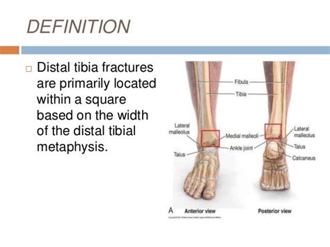 Distal Tibia Fractures