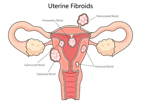 Endometriosis Vs Fibroids American Fibroid Centers