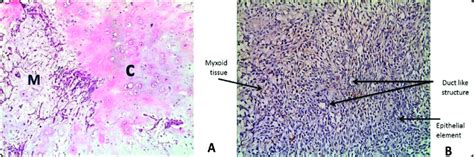 Photomicrograph Of Pleomorphic Adenoma A Illustrating The Myxoid M
