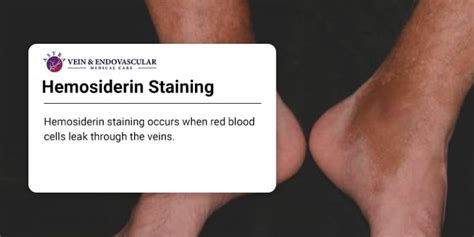 Hemosiderin Staining Why Your Legs Are Turning Brown Vein