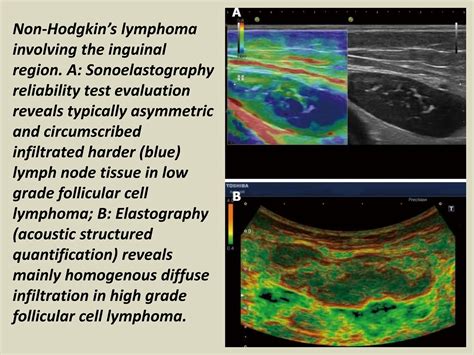 Presentation1 Ultrasound Of The Bowel Loops And The Lymph Nodespptx
