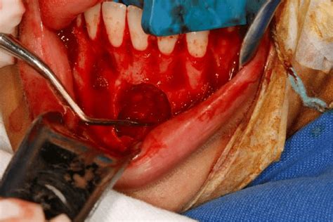 Curettage And Cystic Enucleation Of The Impacted Tooth 43 Download