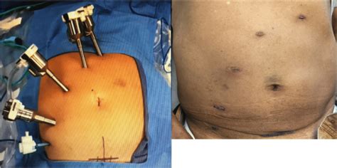 Port Placement And Final Appearance After Robotic Assisted Low Anterior