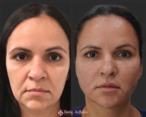 PDO Thread Lifting Before And After Results At Skinly Aesthetics
