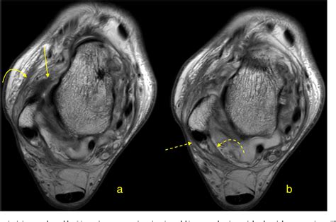 Figure 8 From Peroneus Brevis Split Tear A Challenging Diagnosis A Pictorial Review Of