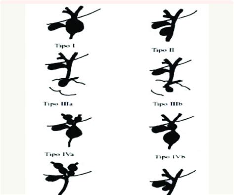 Modified Todani Classification Of Choledochal Cysts Download Scientific Diagram