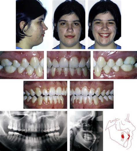 Multiloop Edgewise Archwire In The Treatment Of A Patient With An Anterior Open Bite And A Long
