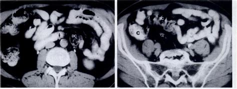 1 Short Descending Mesocolon And Redundant Sigmoid Colon In The Right