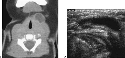 Thyroglossal Duct Cyst Ultrasound Thyroglossal Duct Cyst Radiology