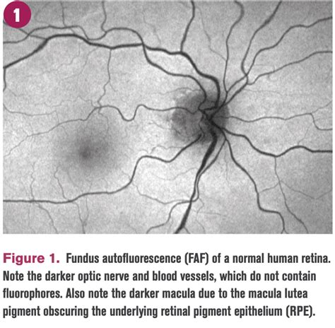 Imaging Helps To Identify Retinal Disease