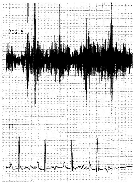 Phonocardiogram Top And Lead Ii Electrocardiogram Bottom Download Scientific Diagram