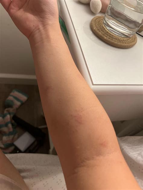 Shingles Mostly Gone How Do I Make It Go Completely Away Rshingles