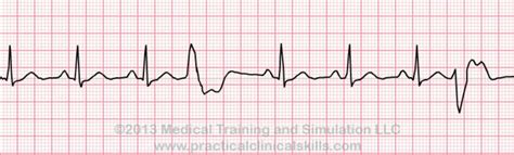 Solved Interpret This Ekga ﻿normal Sinus Rhythm With Two