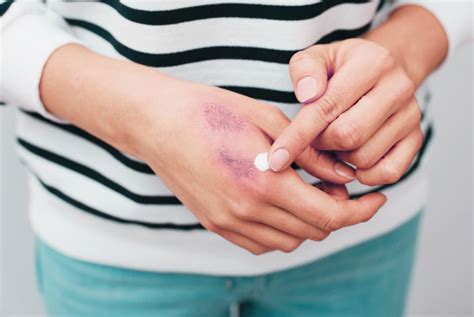 Do Not Apply Toothpaste Cream Or Lotion On Burns Doctor