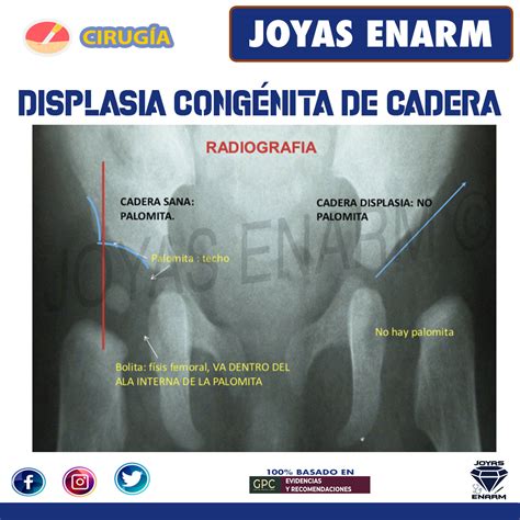 Displasia Congénita De Cadera