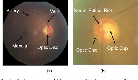 Figure 1 From A Gan Based Domain Adaptation Method For Glaucoma Diagnosis Semantic Scholar