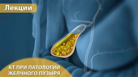 Компьютерная томография при патологии желчного пузыря Андрей Мангов Youtube