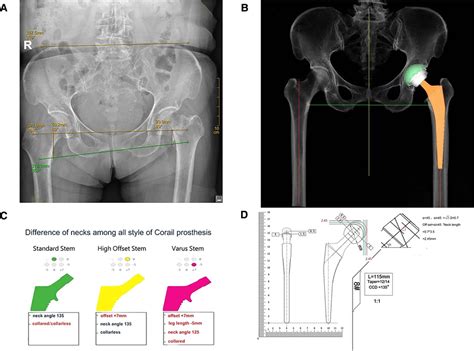 Piriform Fossa Femur
