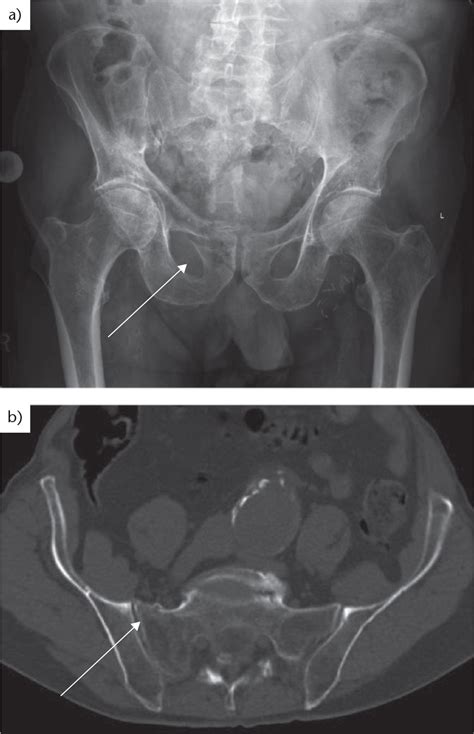 Pelvic Fracture In Elderly Treatment Prognosis Physiotips