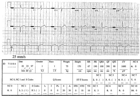 A Simplified Procedure For Coding Of Prevalent Ecg