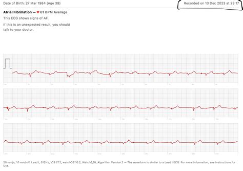 Atrial Fibrillation False Reading R Applewatch