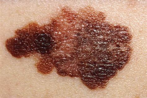 Raised Brown Spots On Body