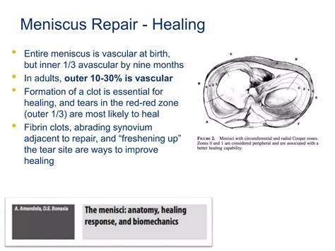 Meniscus Repair With Biologic Augmentation Baton Rouge Sports
