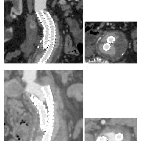 Lateral On The Left And Cross On The Right Views Of Endobag
