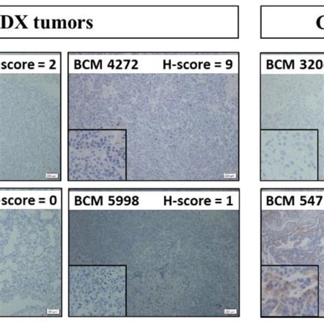 Ihc Analysis Of B Cell Lymphoma 2 Bcl2 Expression With H Score In Download Scientific Diagram