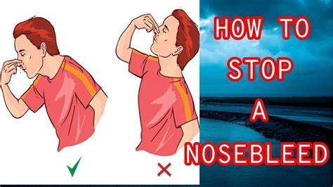 Nose Bleed Causes Diagnosis And Treatment Findatopdoc 58 Off Nose Bleed Causes Diagnosis And Treatment Findatopdoc 58 Off