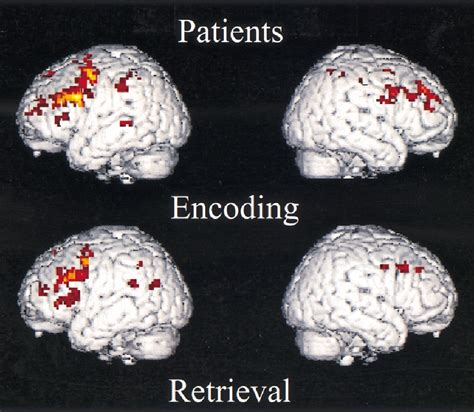 Statistical Parametric Maps Of Mean Activation During The Encoding And Download Scientific