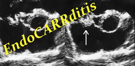 Podcast 166 Endocarditis With David Carr