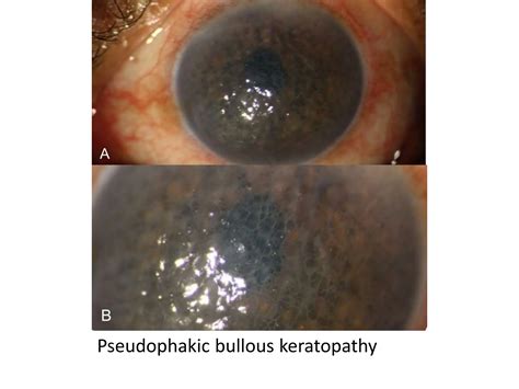 Diseases Of Cornea Keratoconus 222 Pptx