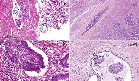 Practical Guidance For Assessing And Reporting Lymphovascular Space Invasion Lvsi In