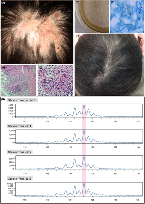 A Clinical Lesion On The Occipital Area Of The Scalp Erythema And Download Scientific