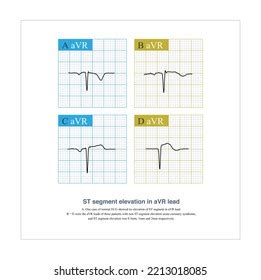 Generally Amplitude St Segment Elevation Avr Stock Illustration