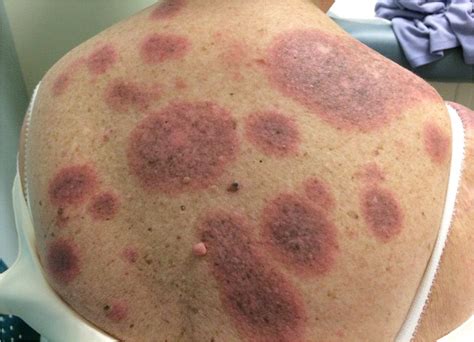 Annular Lesions Diagnosis And Treatment Aafp