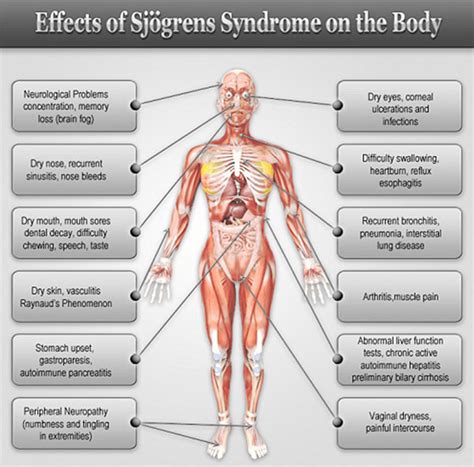 Sjogrens Syndrome Everything You Need To Know About It