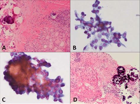 A D Papillary Thyroid Carcinoma Diffuse Sclerosing Variant A On Download Scientific