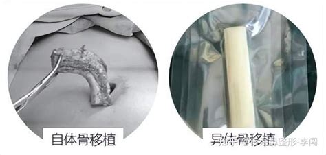 整形材料科普：珊瑚骨是骨粉吗？用来填充脸部安全吗？效果好吗？ 知乎