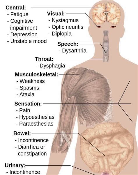 Secondary Progressive Multiple Sclerosis News Research Articles