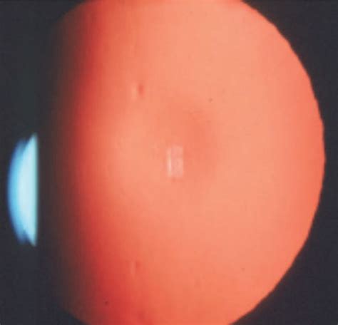 Retinoscopy Reflex In Keratoconus At Jack Huffman Blog