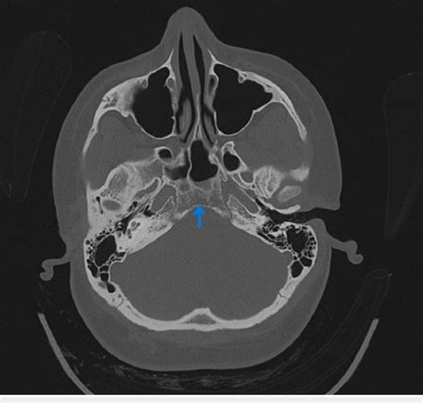 Axial Ct At The Skull Base Reveals Erosion Of Basisphenoid Bone Download Scientific Diagram